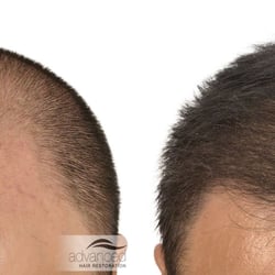 Advanced Hair Restoration - 13 Reviews - Hair Loss Centers - 11040 Main ...