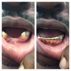 Real Mike Gold Teeth - 30 Photos - Jewelry - 7900 NW 27th Ave, Miami ...